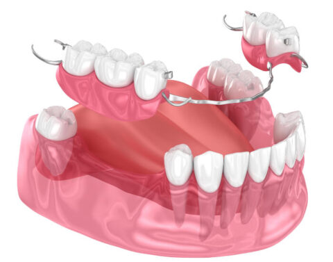 A Dentist in Parker, CO Explains: What is a Dental Flipper?